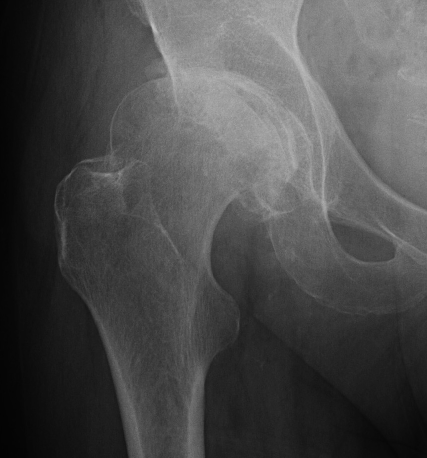 Perthes | The Bone School